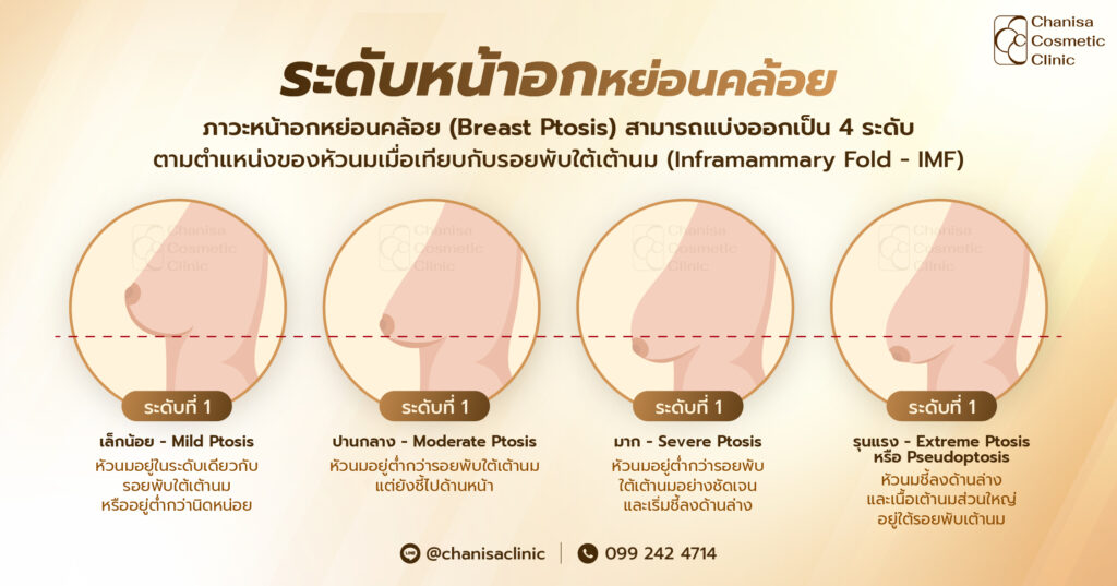 ยกกระชับหน้าอก - Chanisa Cosmetic Clinic