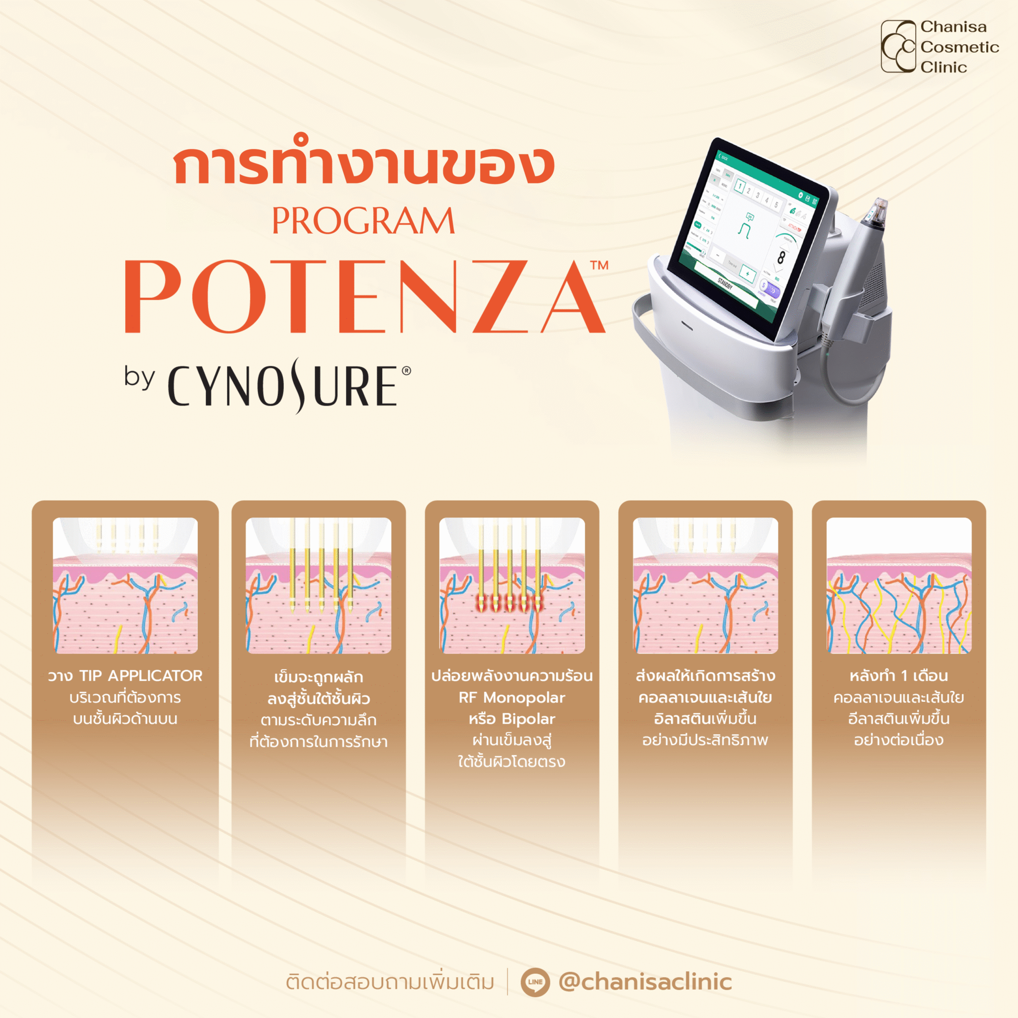 Potenza เครื่องยกกระชับพร้อมงานผิวกระจก - Chanisa Cosmetic Clinic